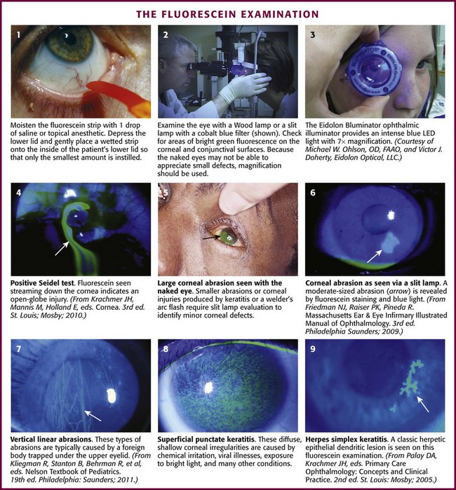 Cpt For Fluorescein Eye Exam Justgoing 2020